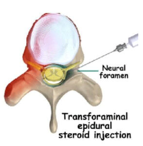 Lumbar Transforaminal Epidural Steroid Injection