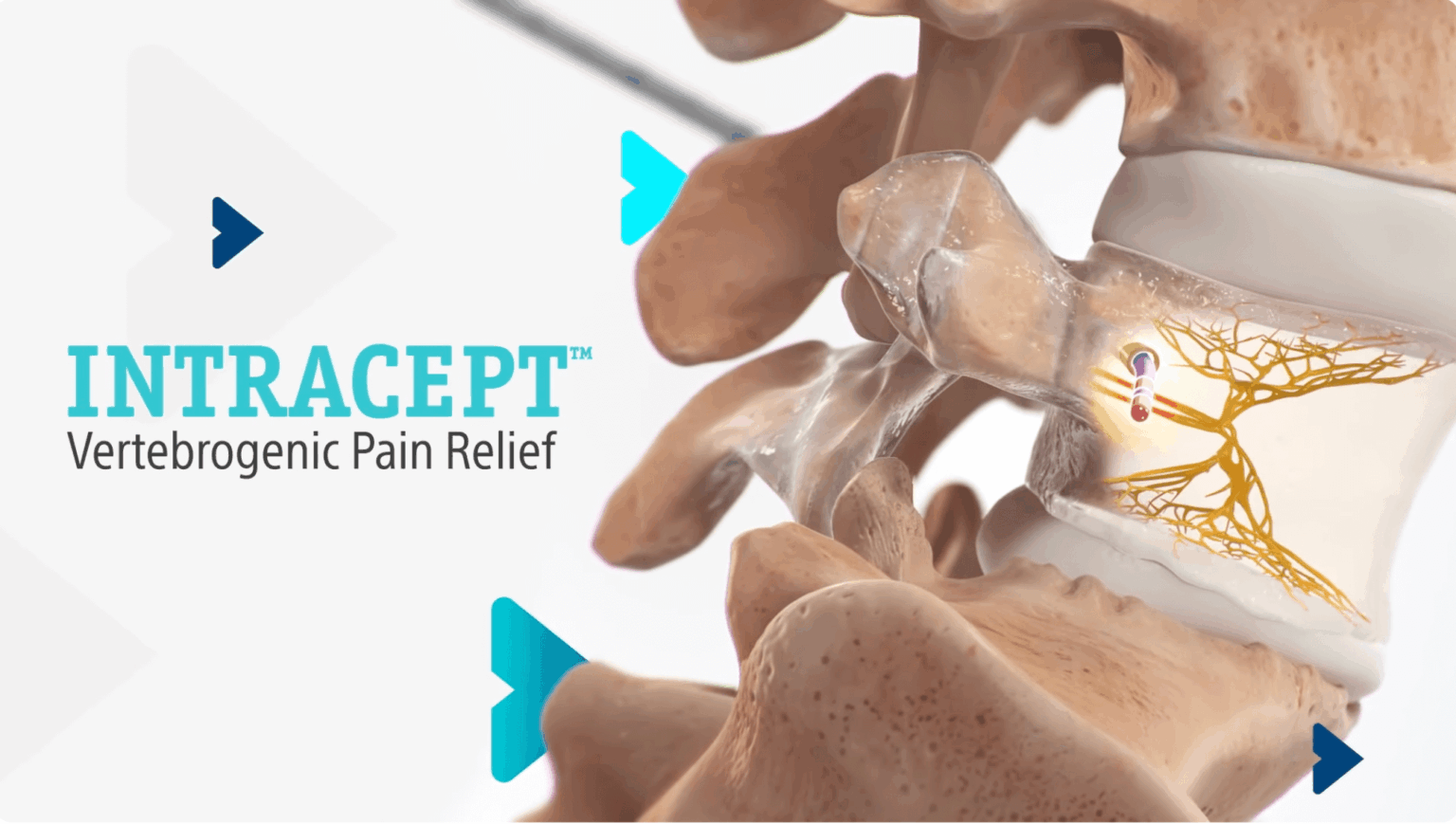Intra-Articular Joint Injection for Joint Pain